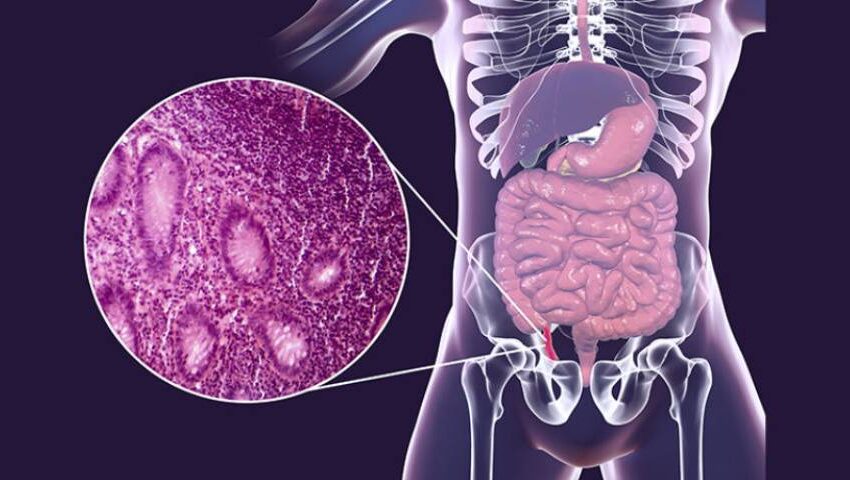 Appendicitis – Inflamed Appendix: Everything You Should Know