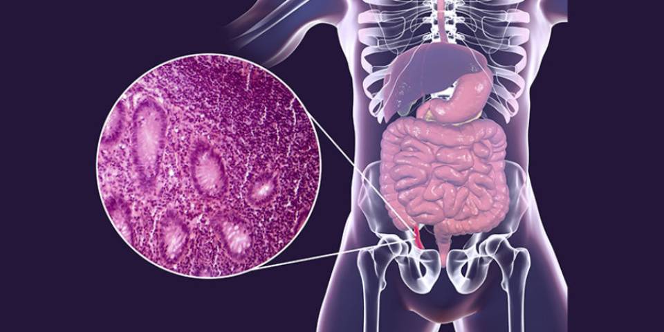 Appendicitis – Inflamed Appendix: Everything You Should Know