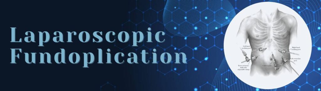Laparoscopic Fundoplication Surgery in Pune, India | Laparoscopic ...