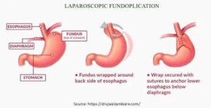 Upper GI Surgery in Pune, India | GI Surgery- Dr. Samrat Jankar