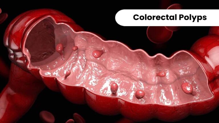 Colorectal Polyps: Should You Be Worried?