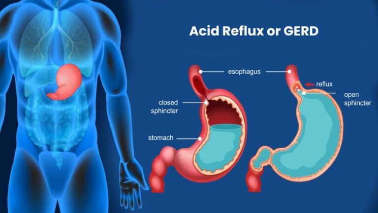GERD Surgery in Pune | Lasting Relief from Acid Reflux by Dr. Samrat Jankar